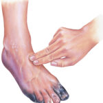 Critical Limb Ischemia Treatment | The Vascular Care Group