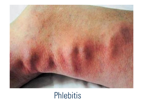 Phlebitis | The Vascular Care Group